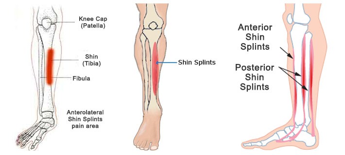SHIN SPLINTS SHIN SPLINTS